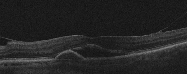 Advanced Care for Macular Degeneration at Nexus Eye Care Clinic