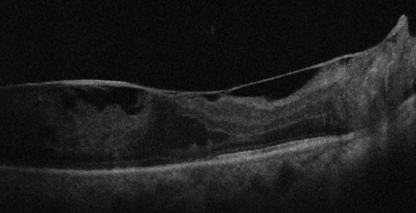 Advanced Vitrectomy Procedures for Retinal Disease at Nexus Eye care Clinic