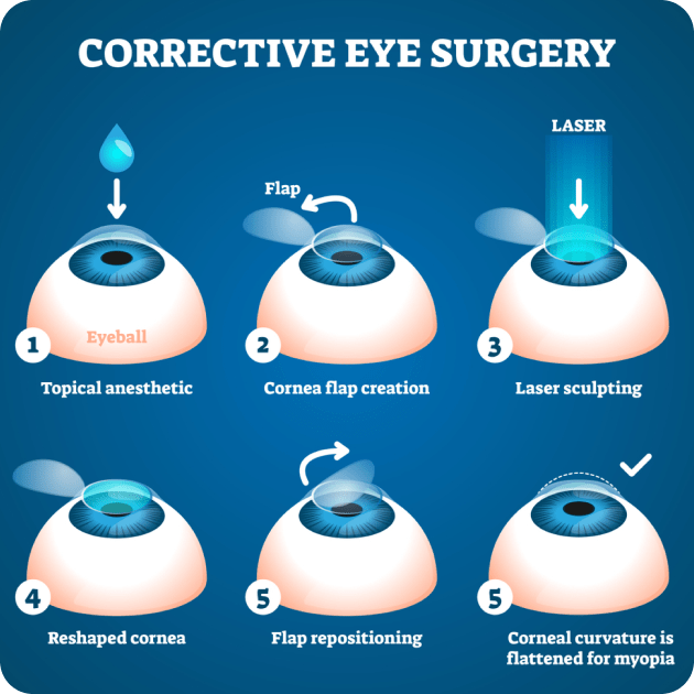 Laser Eye Surgery