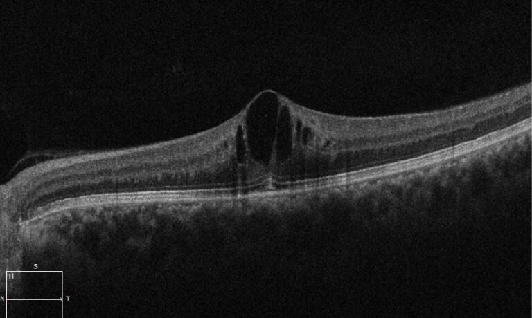 Eye Health Wisdom | Nexus Eye Care Clinic Blogs